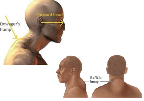 Dowager’s ή Buffalo Hump - Physioline